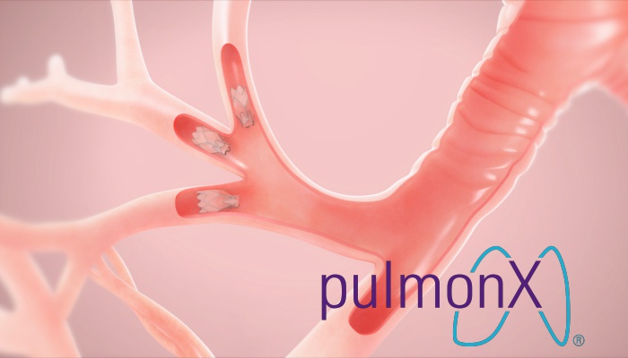 Pulmonx touts new coverage for Zephyr valve - MassDevice