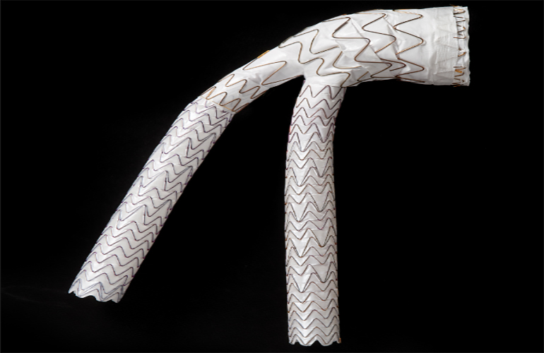 Gore’s aneurysm device for tricky anatomies implanted in Europe ...