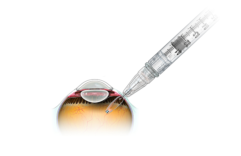 FDA accepts biologics license application for Genentech’s drug-eluting ...