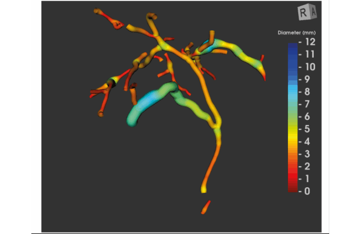 Perspectum wins FDA nod for biliary duct mapping software - MassDevice
