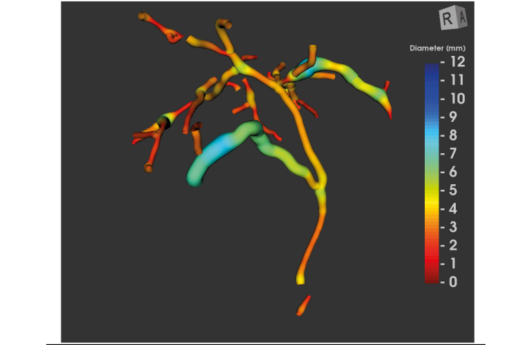 Perspectum wins FDA nod for biliary duct mapping software - MassDevice