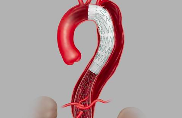 First U.S. patient treated with Cook Medical endovascular aortic ...