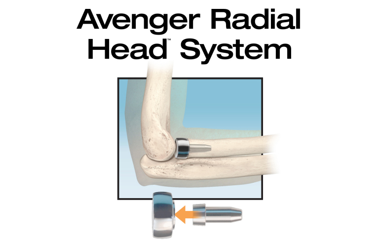 In2Bones launches single-use delivery system for radial head ...