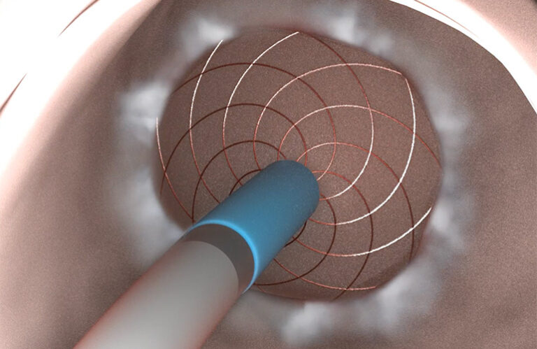 Aqua Medical wins FDA IDE for ablation procedure for diabetes