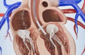 VenstraMedical picks up investment for ventricular assist device