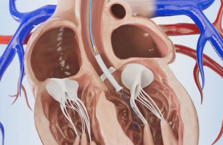 VenstraMedical picks up investment for ventricular assist device