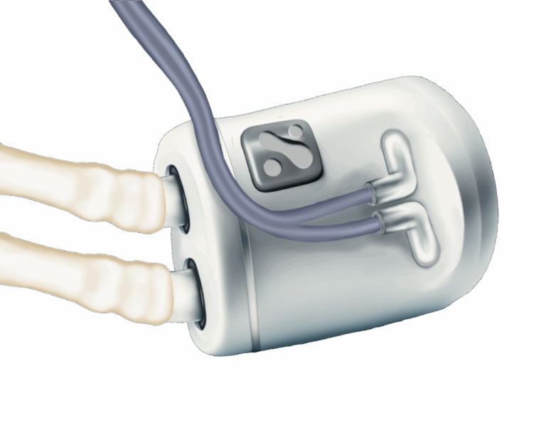 Nephrodite gets FDA TAP nod for implantable dialysis system