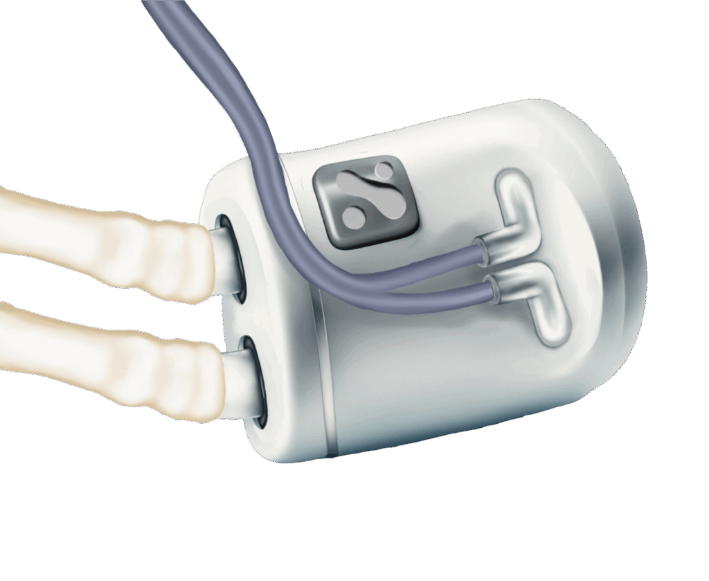 Nephrodite's continuous dialysis implant wins FDA Breakthrough Designation