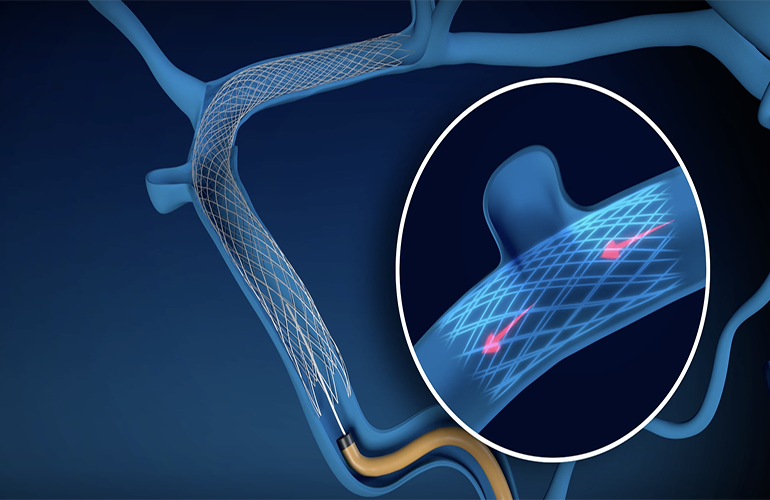 Sonorous Neurovascular earns FDA breakthrough mark for novel stent