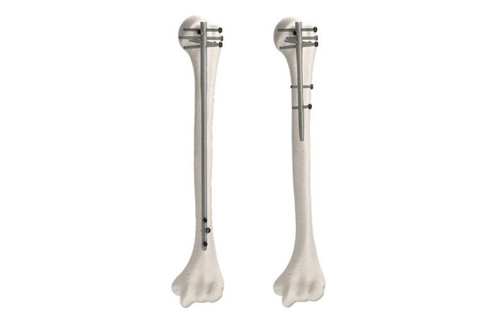 Stryker launches T2 Alpha humerus nailing system, expands trauma ...