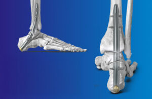 Zimmer Biomet announces commercial launch of curved TTC nail system