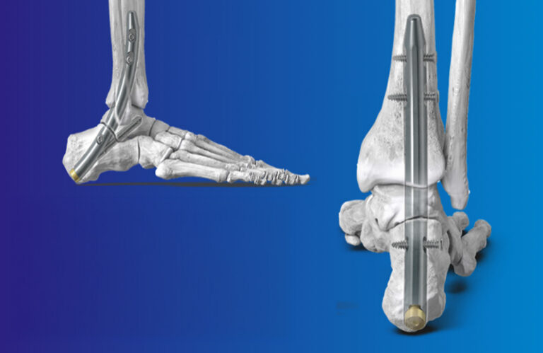 Zimmer Biomet announces commercial launch of curved TTC nail system