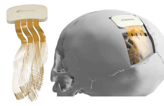 ReVision Implant wins breakthrough nod for vision-restoring BCI