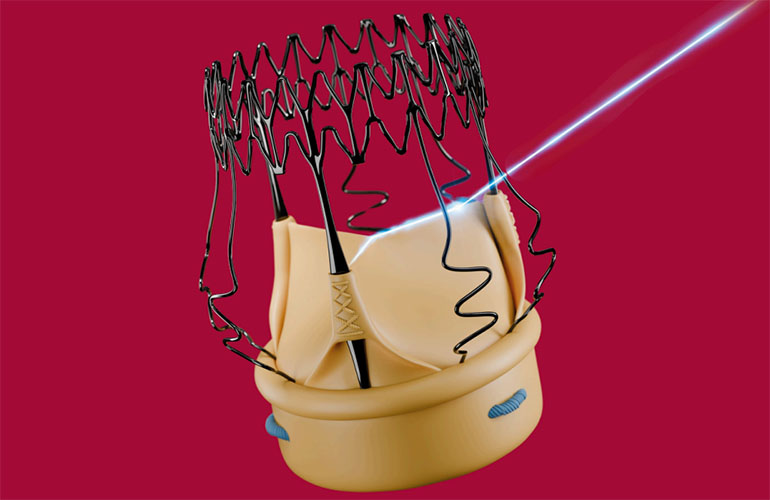 Corcym reports first U.S. implant of next-gen sutureless aortic valve