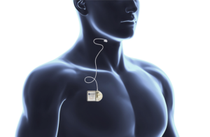 LivaNova shares positive data for sleep apnea therapy