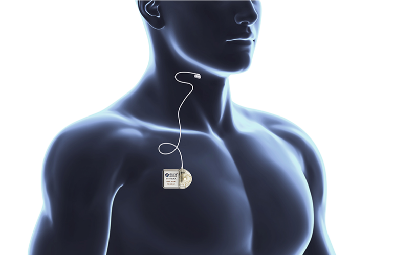 LivaNova wins FDA PMA for neuromod for sleep apnea