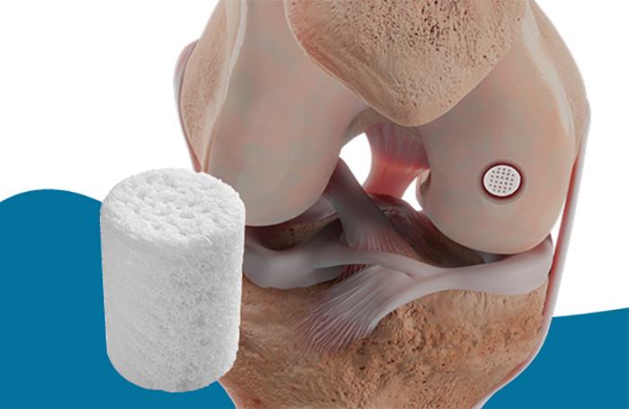 Smith+Nephew study backs cartilage repair implant