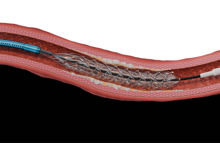 Reflow Medical has positive data for coronary drug-eluting stent