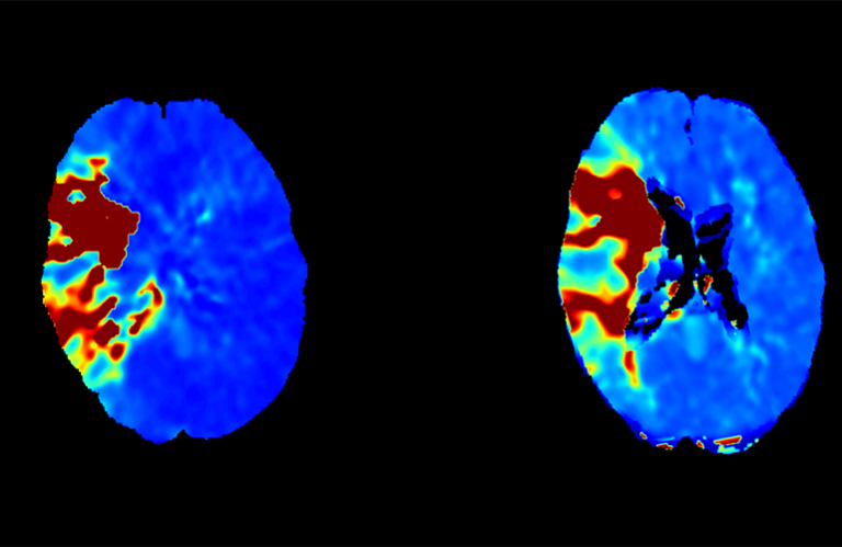 Siemens Healthineers, Cercare collab on image-guided stroke tech