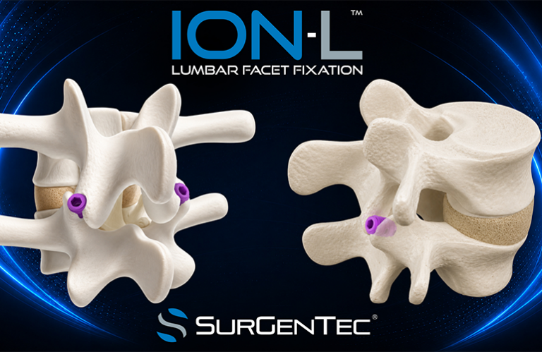 SurGenTec gets FDA nod for lumbar facet fixation system